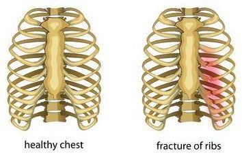 Physical Therapy for a Rib Fracture - TheraMAX Rehabilitation